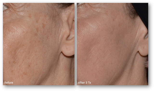 LaseMD Ultra - San Antonio & Boerne Dermatologist