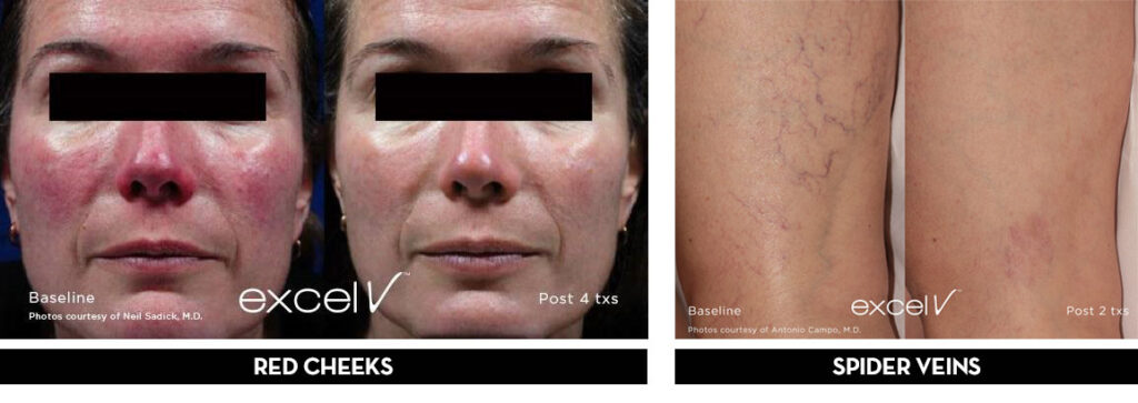 It's Laser Season! - San Antonio & Boerne Dermatologist