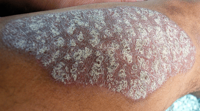 Psoriasis Seasonal Flare-Ups - San Antonio & Boerne Dermatologist