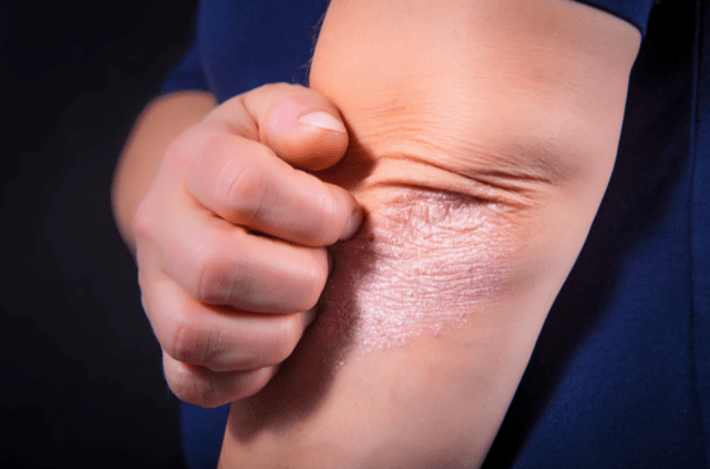 Psoriasis Seasonal Flare-Ups - San Antonio & Boerne Dermatologist